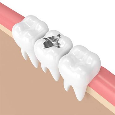 Amalgam Filling Removal | Dr Finkelstein Dentist Sydney